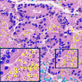 Sfcn-opi: Detection and fine-grained classification of nuclei using sibling fcn with objectness ...