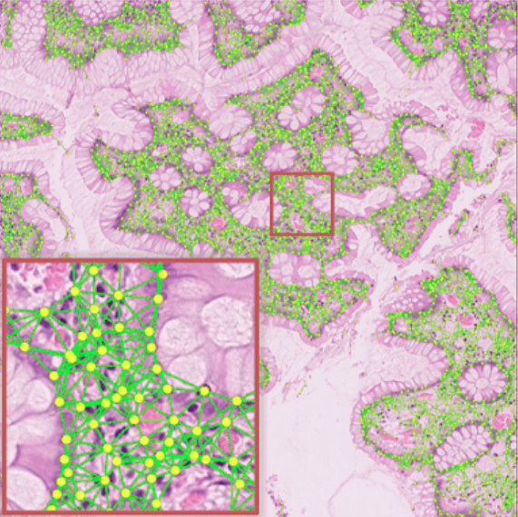 Cgc Net Cell Graph Convolutional Network For Grading Of Colorectal